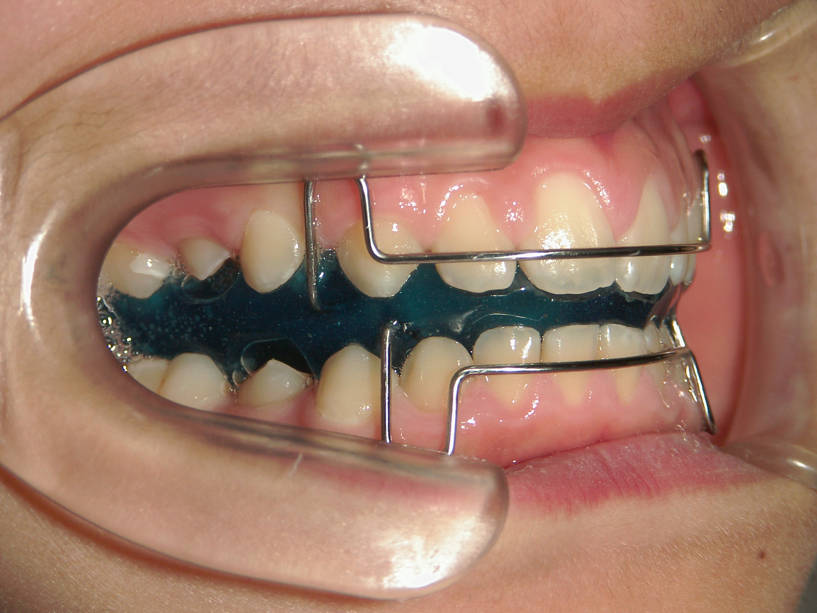 フミヤの矯正日記：FKOを開始です！ | CALLA's BLOG